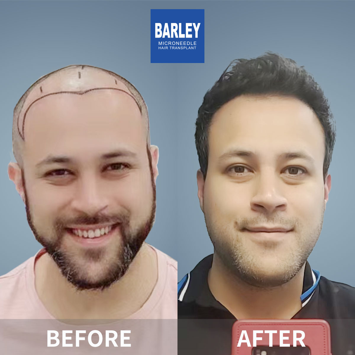 Hair Transplant in China-Hair, Beard and Eyebrows Transplant Hospital